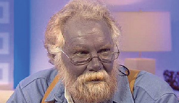 Knowing the rather weird Blue Skin Disorder - ExHealth